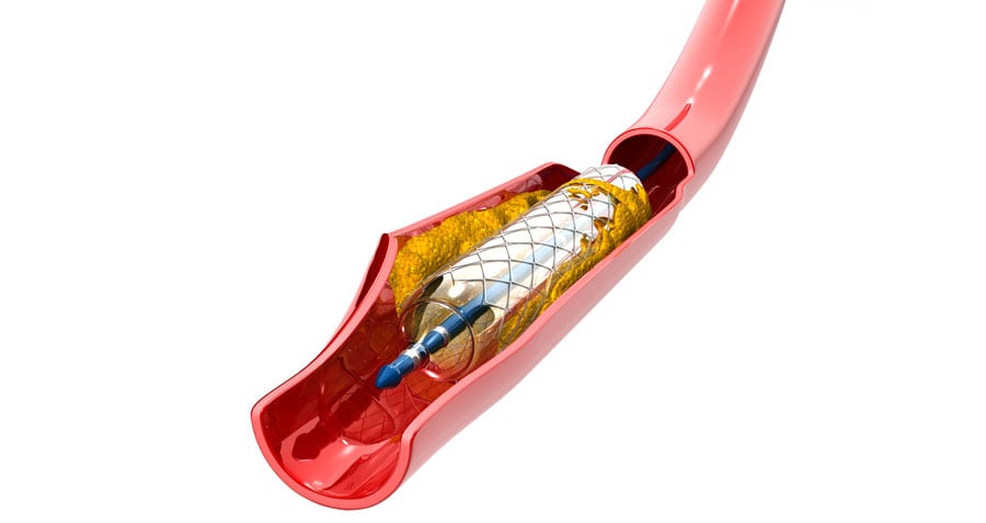 Conformal Coating Spotlight: Medical Parylene